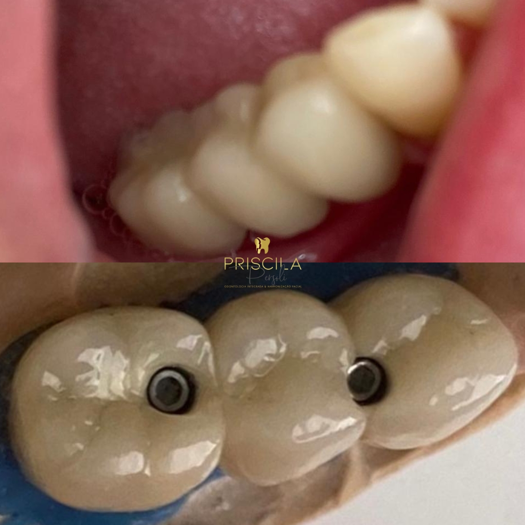 Preenchimento De Olheiras Dra Priscila Persoli Agende Sua Avaliação