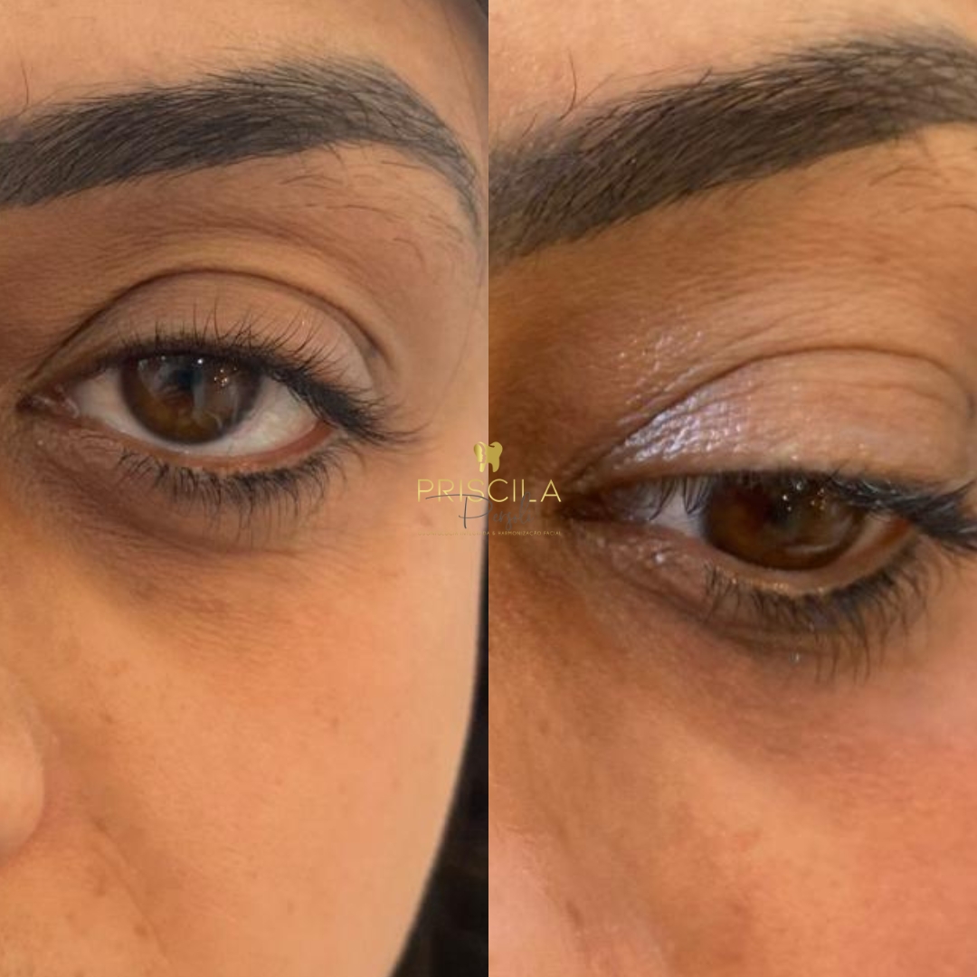 Preenchimento De Olheiras Dra Priscila Persoli Agende Sua Avaliação